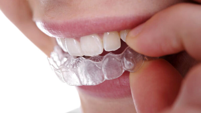 Retainer-Aligner-Invisalign, dan Behel: Memahami Perbedaan dan ...