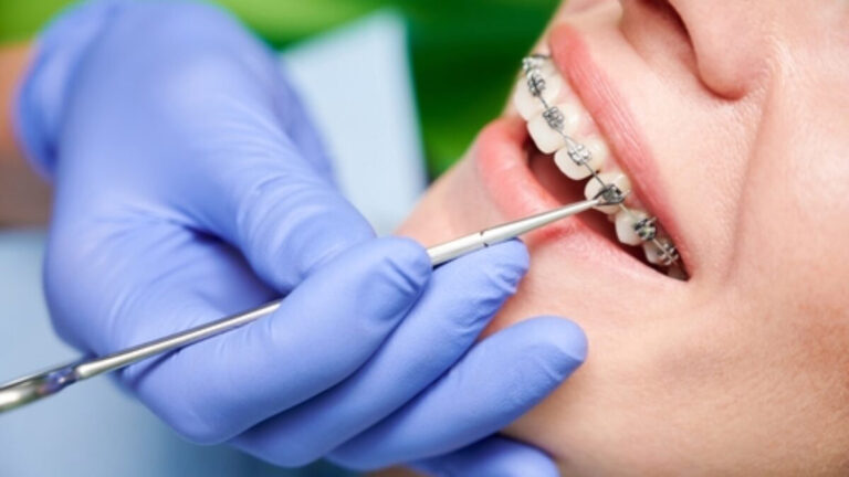 Retainer-Aligner-Invisalign, dan Behel: Memahami Perbedaan dan ...